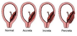 Placenta Accreta - What is, Symptoms, Risk Factors, Diagnosis