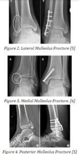 Trimalleolar Fracture - Recovery Time, Surgery, Prognosis, Symptoms